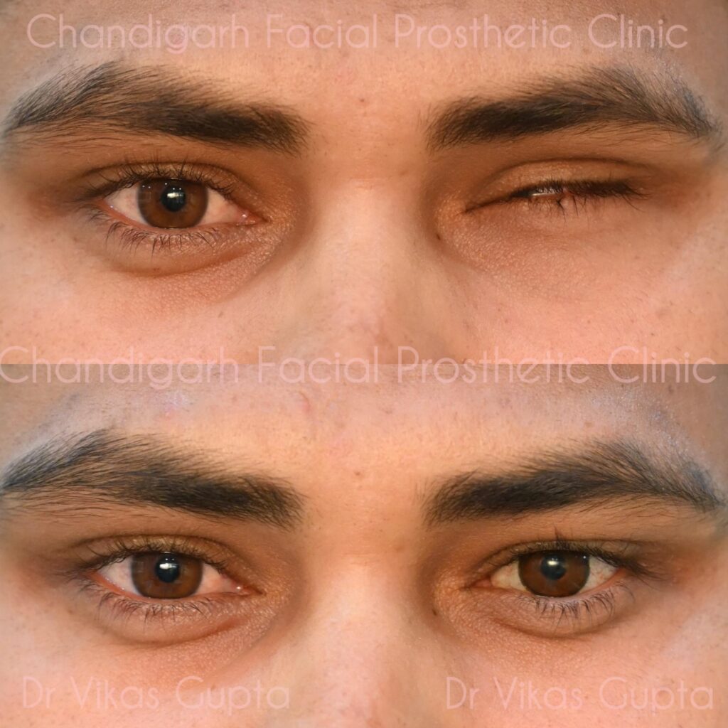 What is Custom Ocular Prosthesis? - Chandigarh Facial Prosthesis Clinic